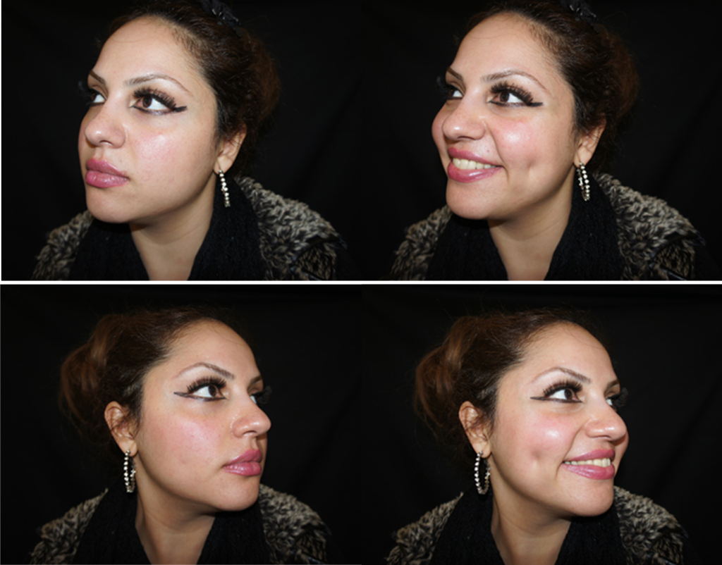 Facts, Fiction and Fashion – Facial Dimple Creation 14 Years Of ...