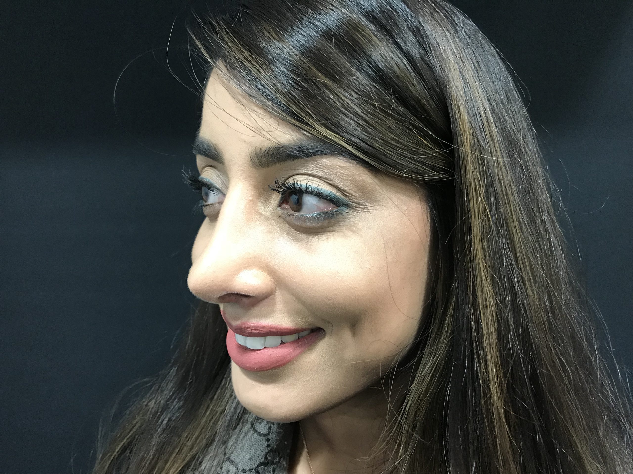 Dimple Creation at MACS Clinic, London/Watford – 15 years of experience ...